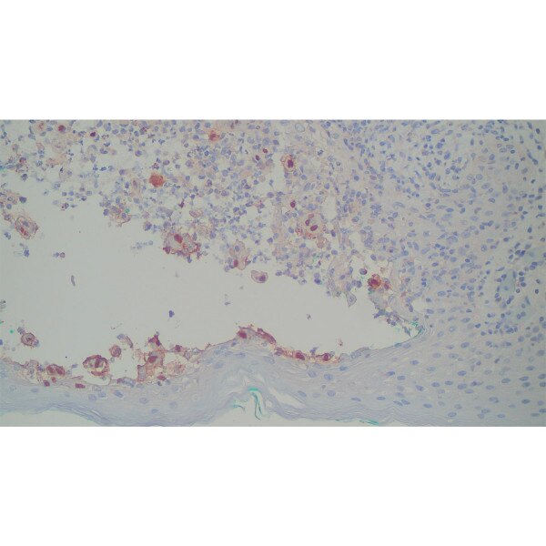 Histology IHC stain, HERPES SIMPLEX VIRUS I & II | Azer Scientific